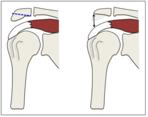 Acromioplastie-optez pour l'Expertise du Dr Ghamgui